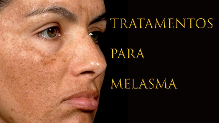 Melasma: Métodos para Eliminar Manchas na Pele - Fadinha Magica
